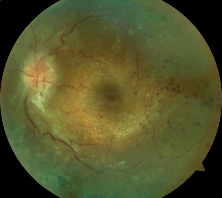 Gallery | Retina & Vitreous of Louisiana