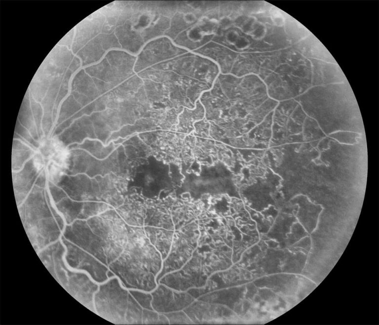 Gallery | Retina & Vitreous of Louisiana